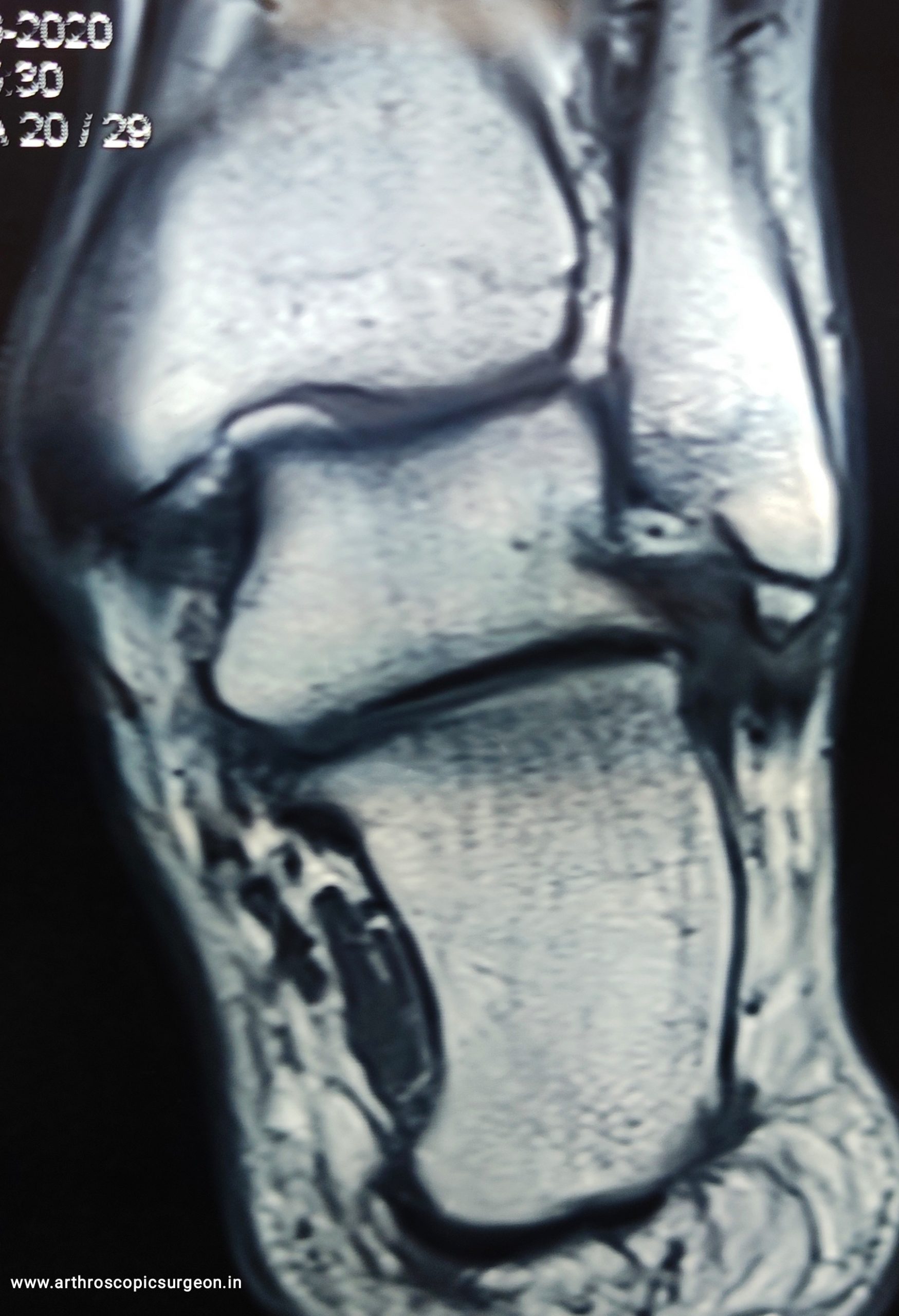 Ankle sprain – Best Orthopedic doctor in Jaipur