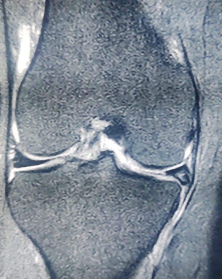 Meniscus tear – Meniscectomy or Repair – Best Orthopedic doctor in Jaipur