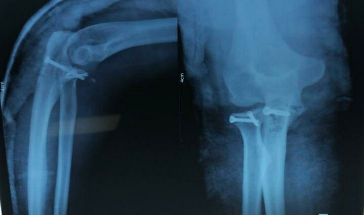 Terrible triad elbow – Best Orthopedic doctor in Jaipur