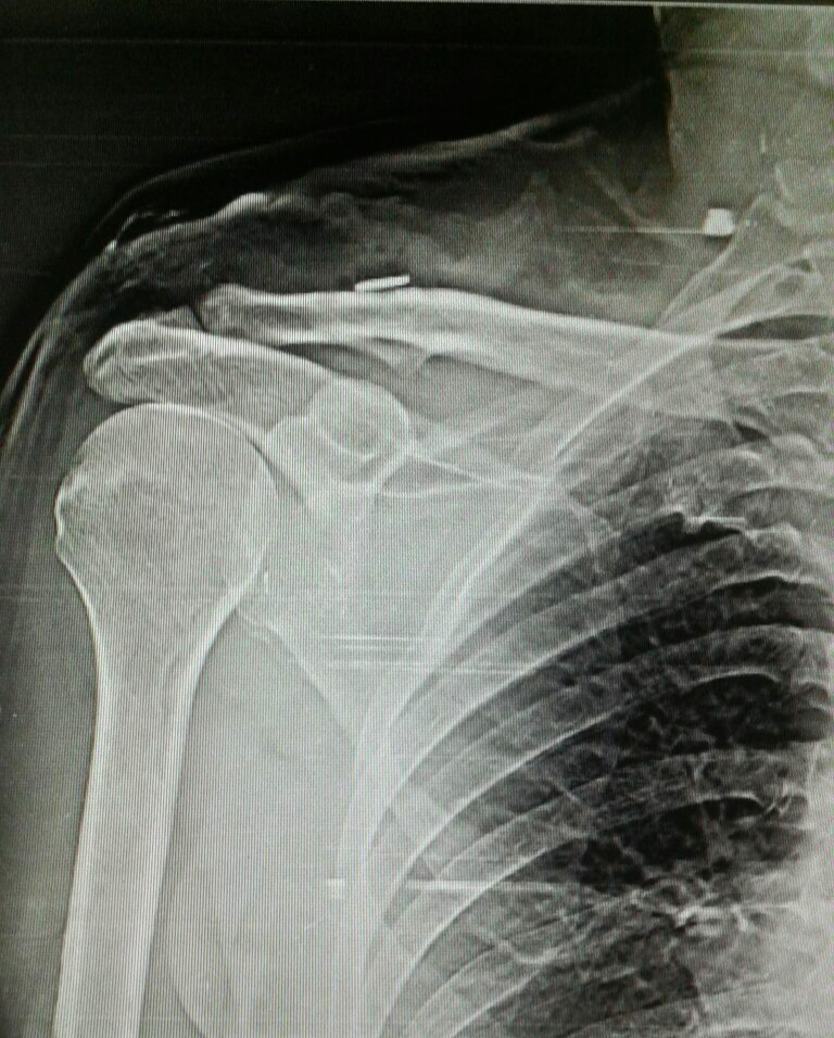 ac joint dislocation – Best Orthopedic doctor in Jaipur