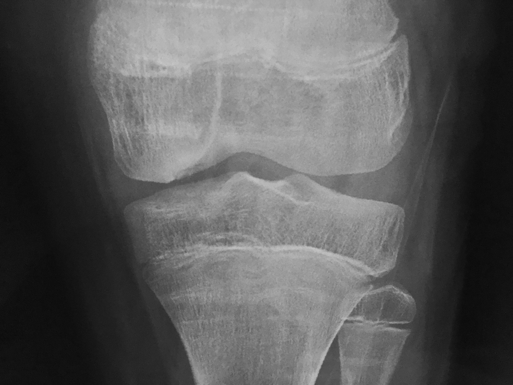 OCD (Osteochondritis dissecans/Ostochondral disease) – Best Orthopedic ...