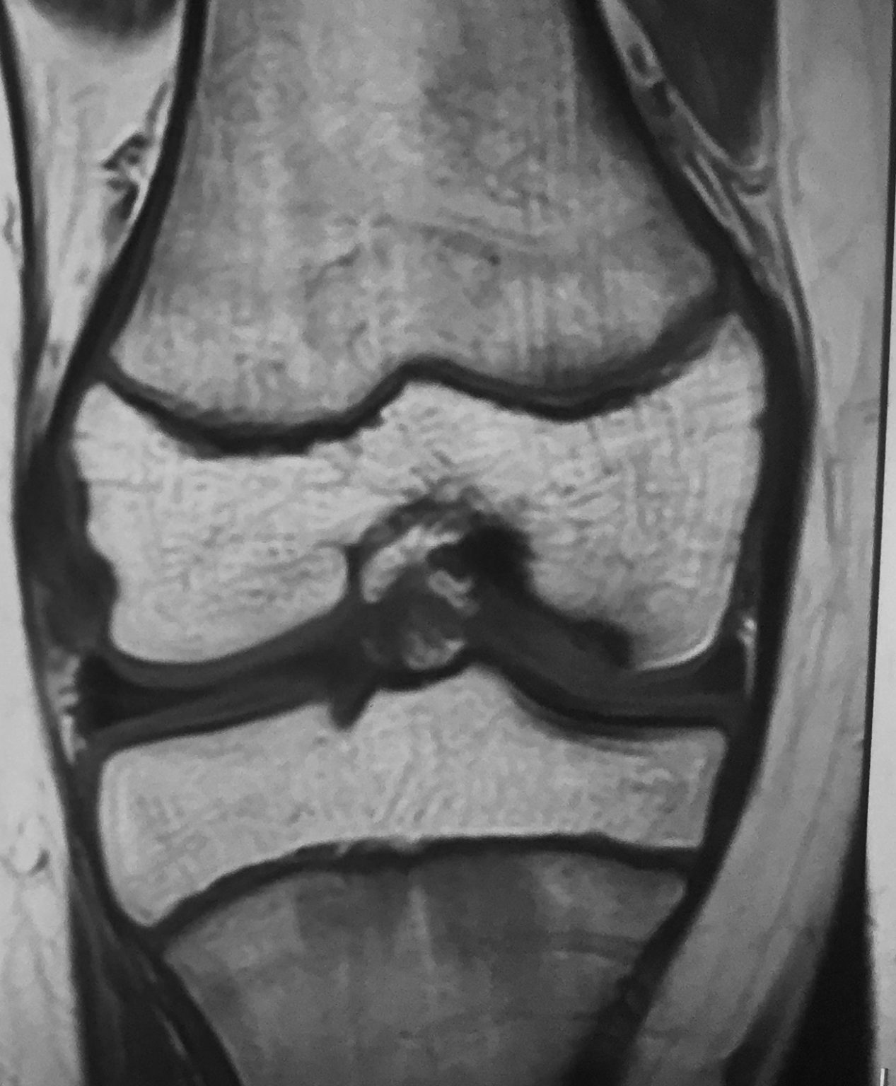 OCD (Osteochondritis dissecans/Ostochondral disease) – Best Orthopedic ...