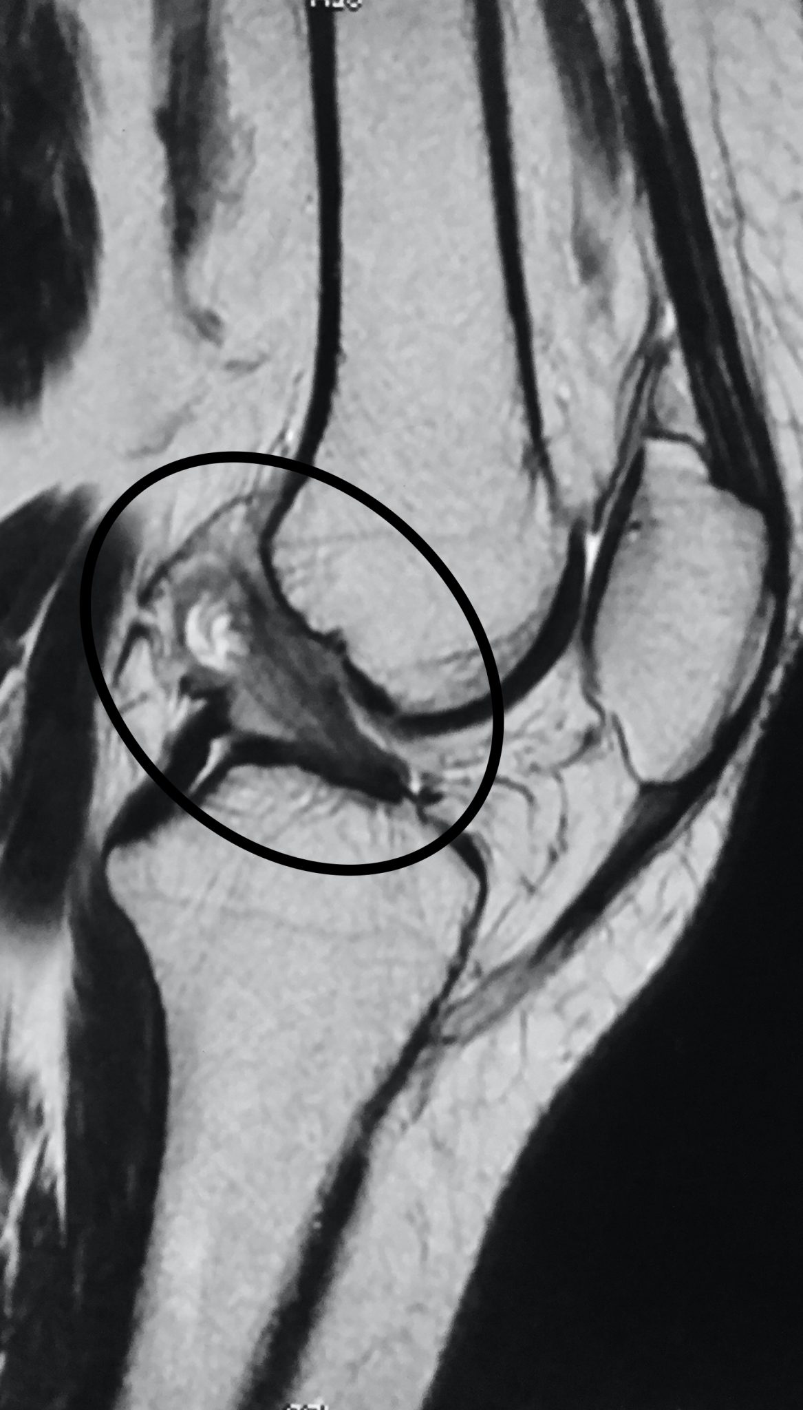 mucoid degeneration of acl – Best Orthopedic doctor in Jaipur